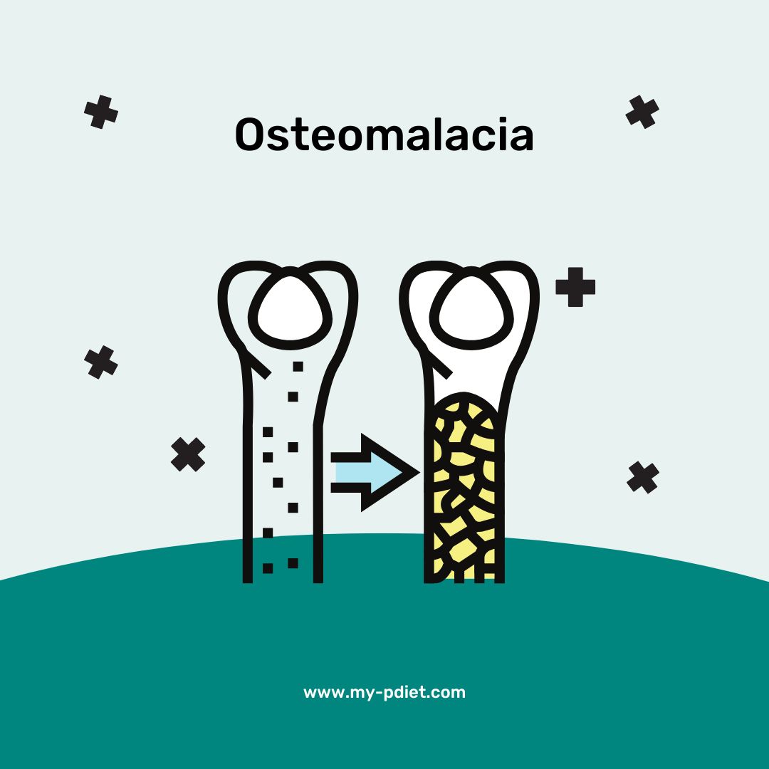 Osteomalacia - My-PDiet.com - Nutrición